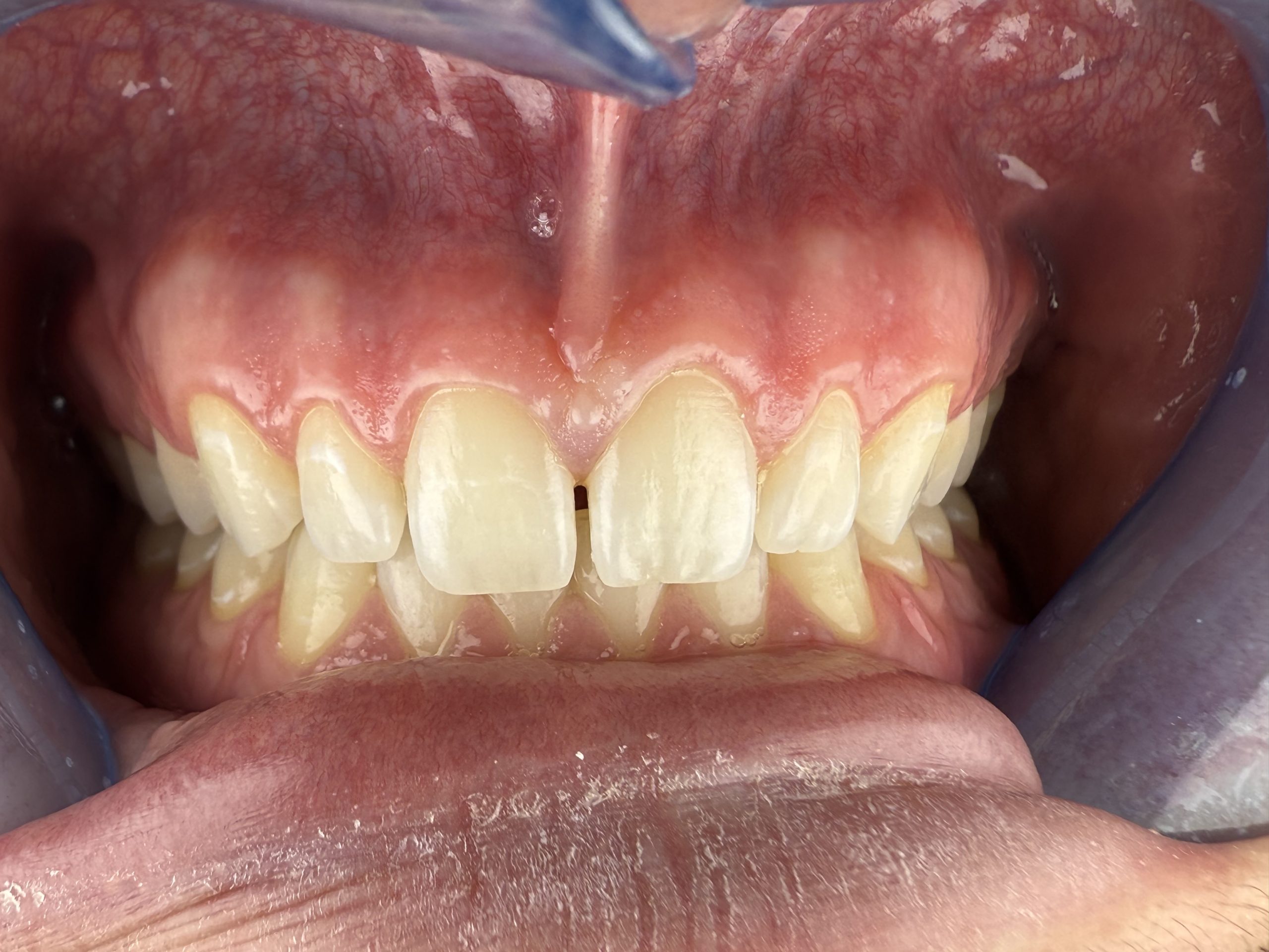 Before & After | Yorba Linda Elite Dental