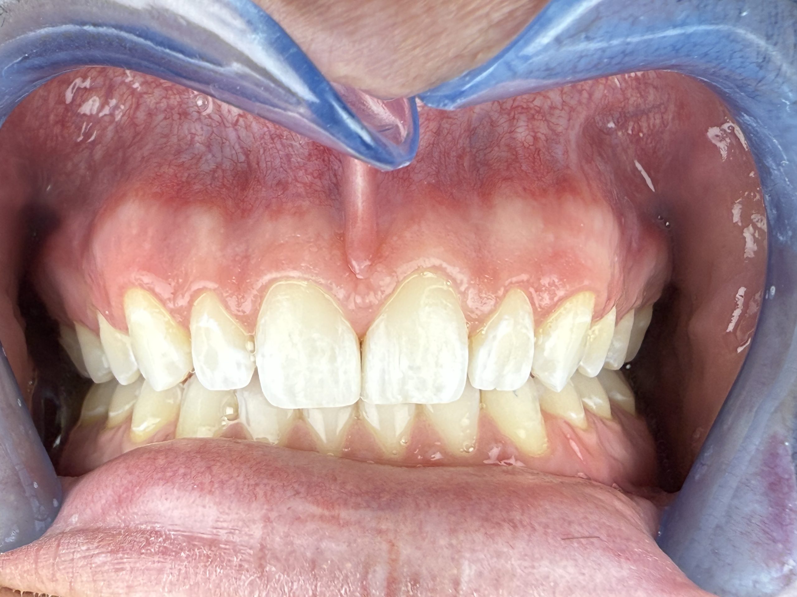 Before & After | Yorba Linda Elite Dental