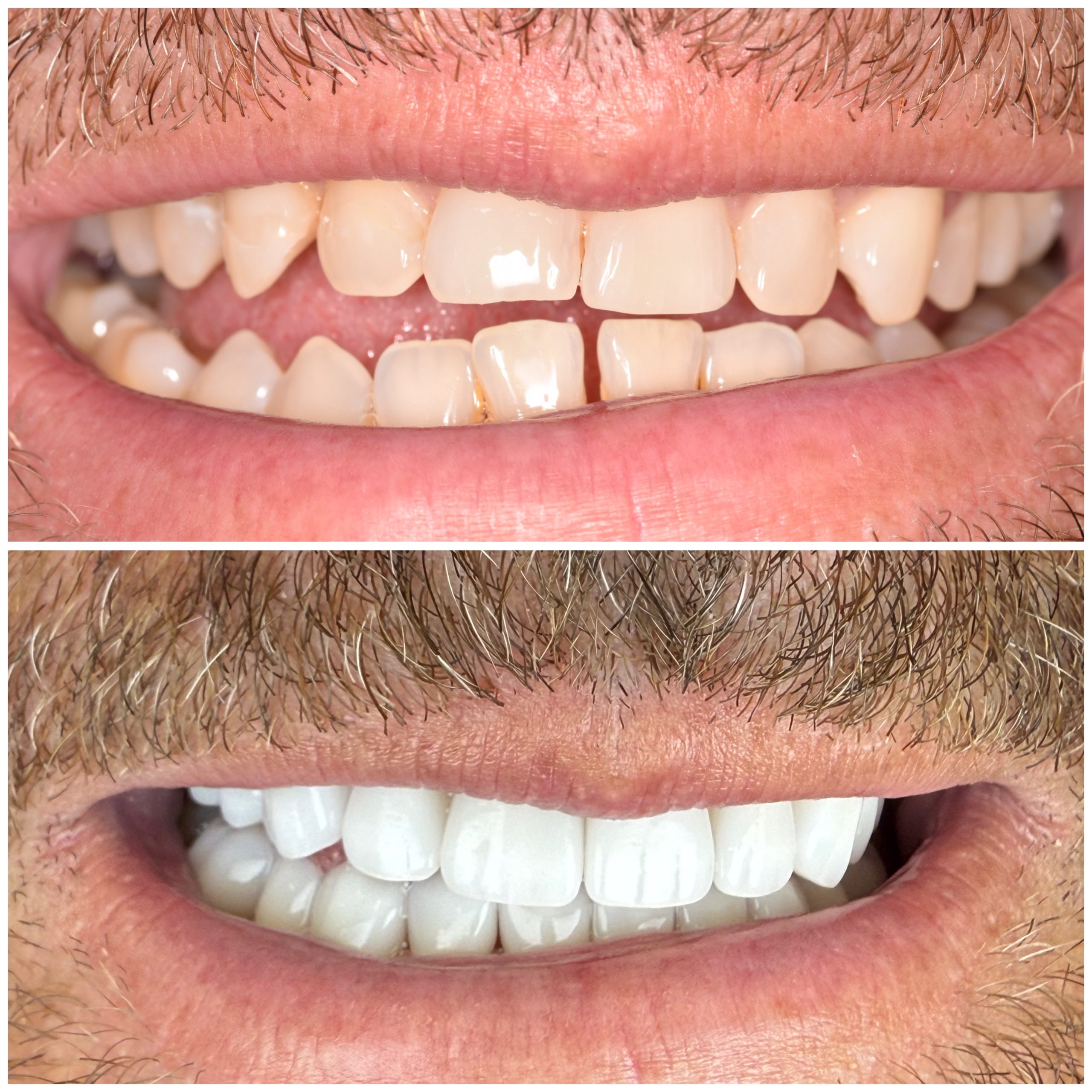 Before & After | Yorba Linda Elite Dental