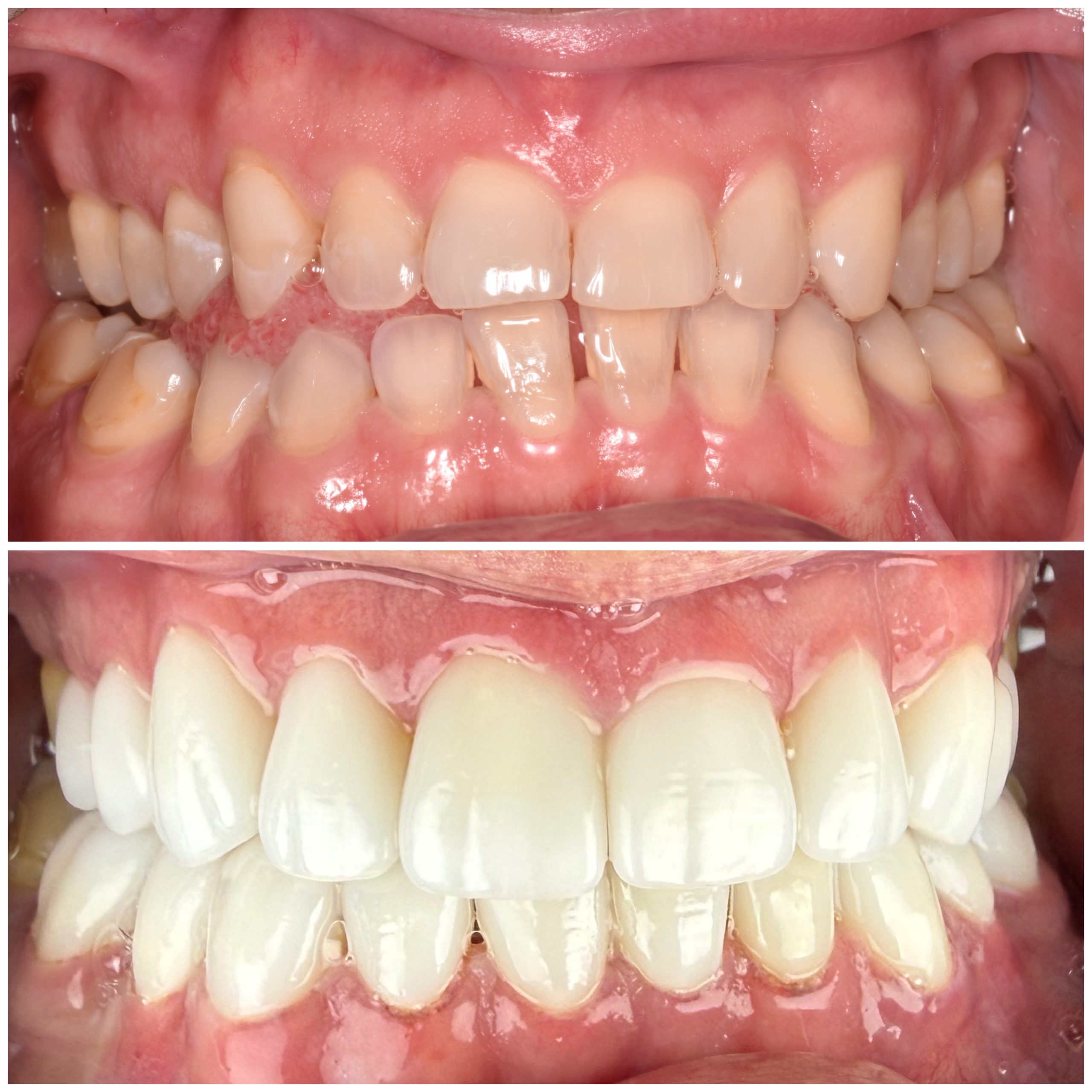 Before & After | Yorba Linda Elite Dental